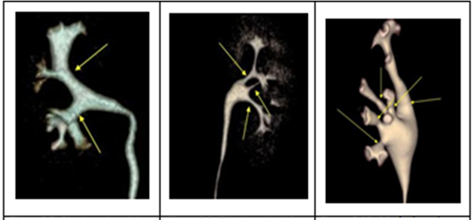 Analysis Of Morphology Of Renal Calyceal Pattern In Renal Donors Using ...